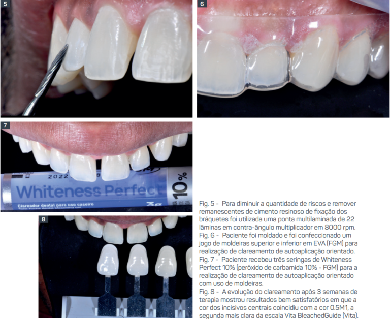 Estratificar Ou Simplificar Com Resinas Compostas Sorria Sempre Que